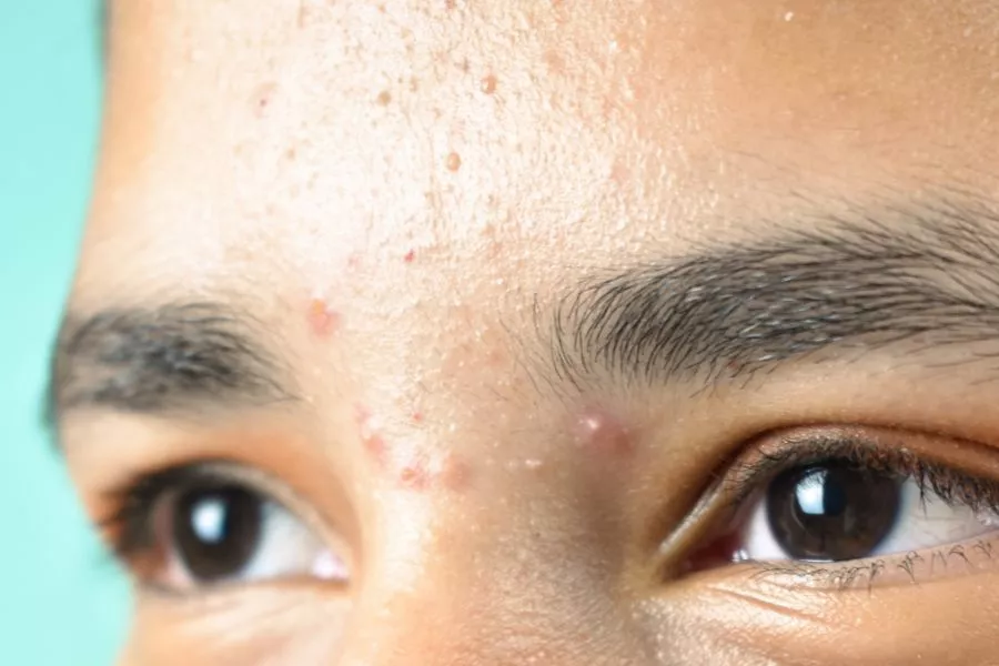 6 Penyebab Bruntusan di Jidat, Waspadai jika Ingin Kulit tetap Bersih